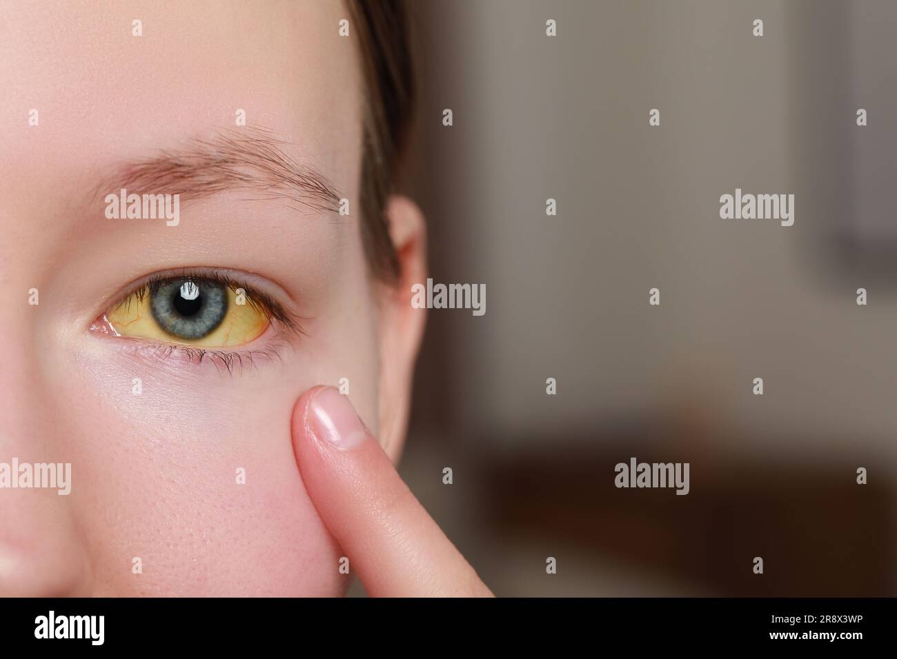 Woman with yellow eyes on blurred background, closeup. Symptom of ...