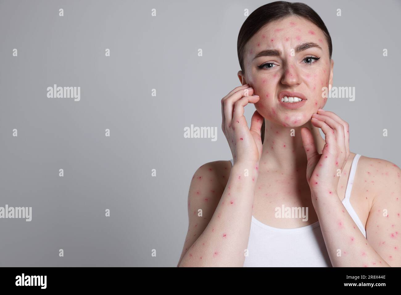 Woman with rash suffering from monkeypox virus on light grey background ...