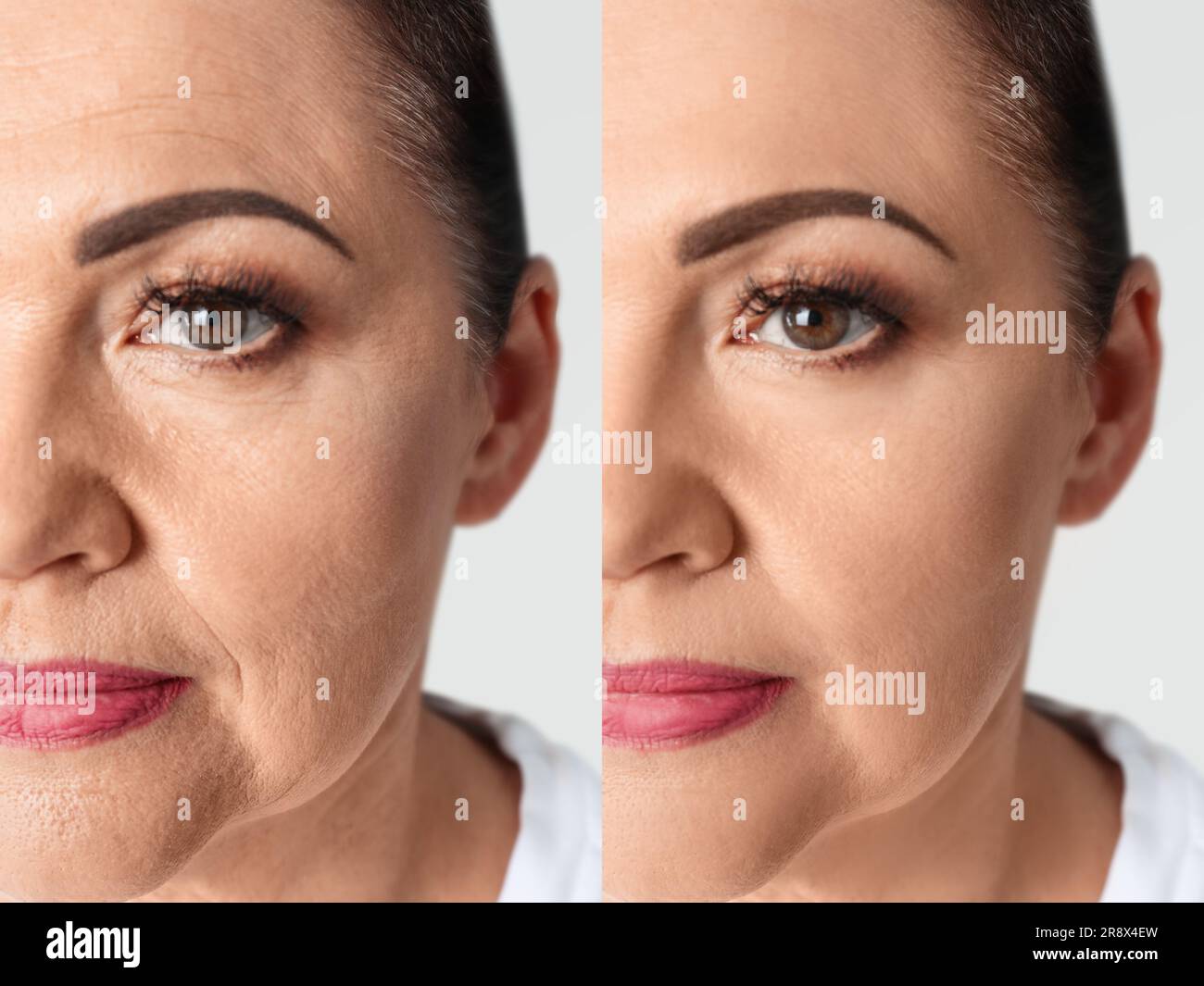 Woman looking better due to cosmetic procedures, closeup. Collage with ...