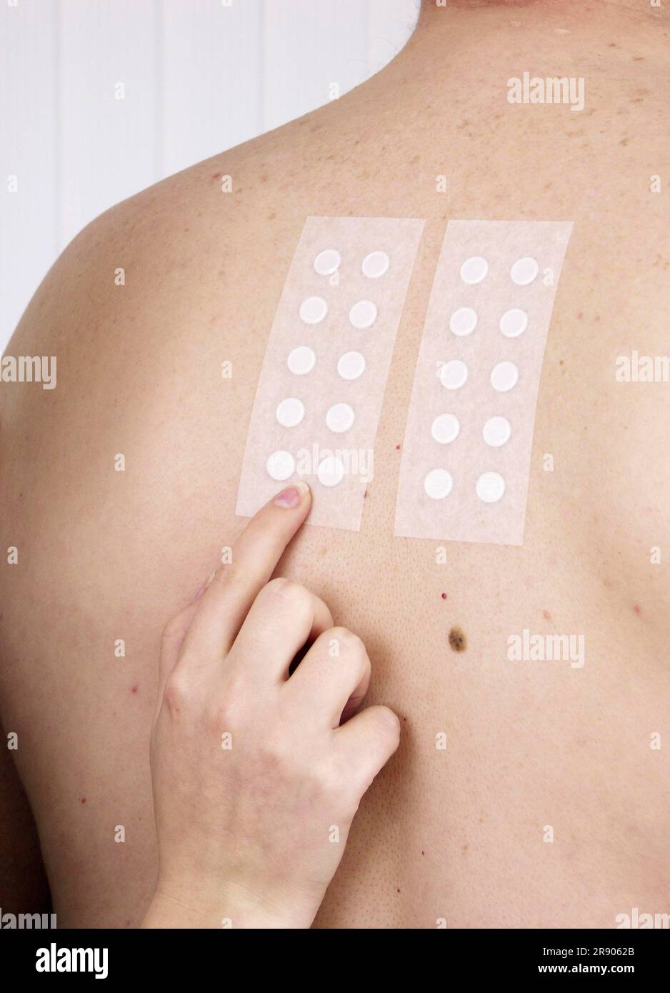 Allergy test, sticking plasters, allergy, testing Stock Photo - Alamy