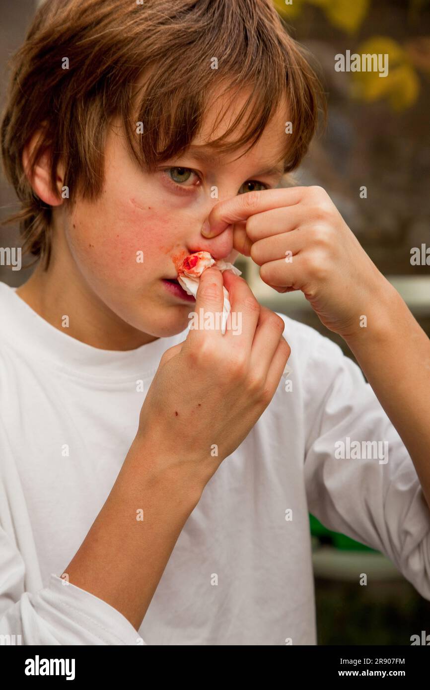 Netherlands, boy with a nosebleed Stock Photo - Alamy
