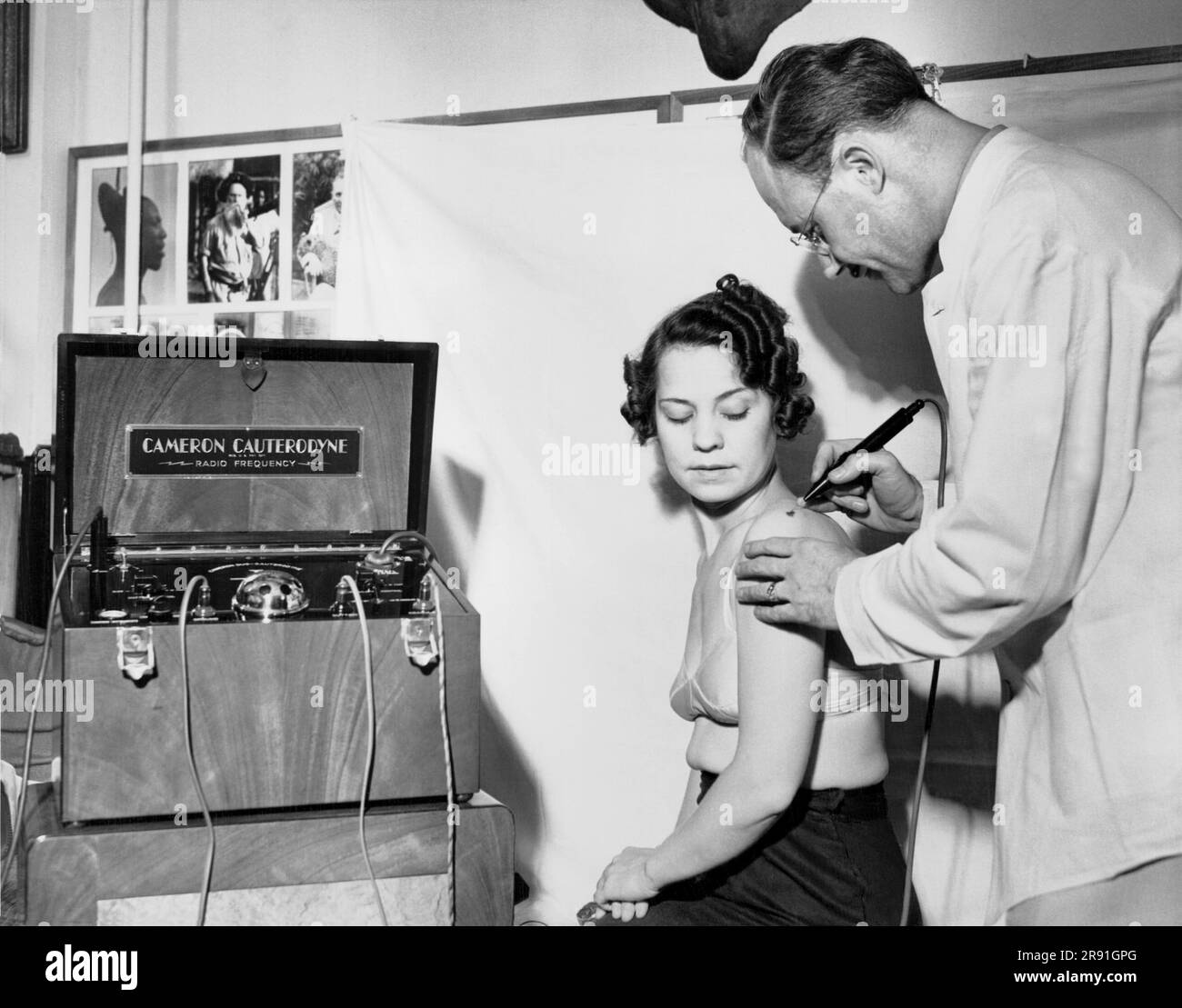 United States: c. 1934 A doctor removing a skin growth from a patient's ...