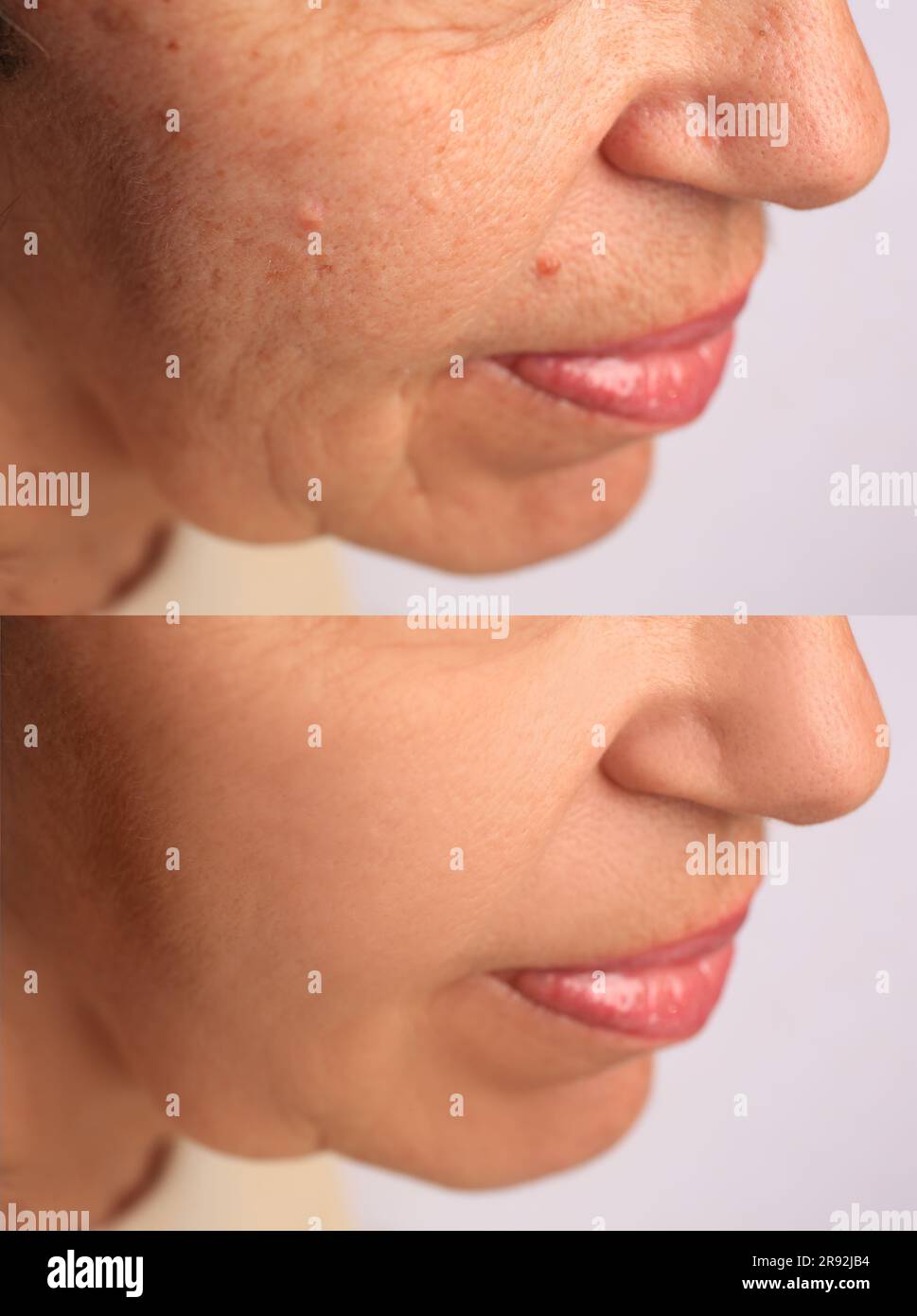 Woman before and after rejuvenating procedures. Collage with photos on ...