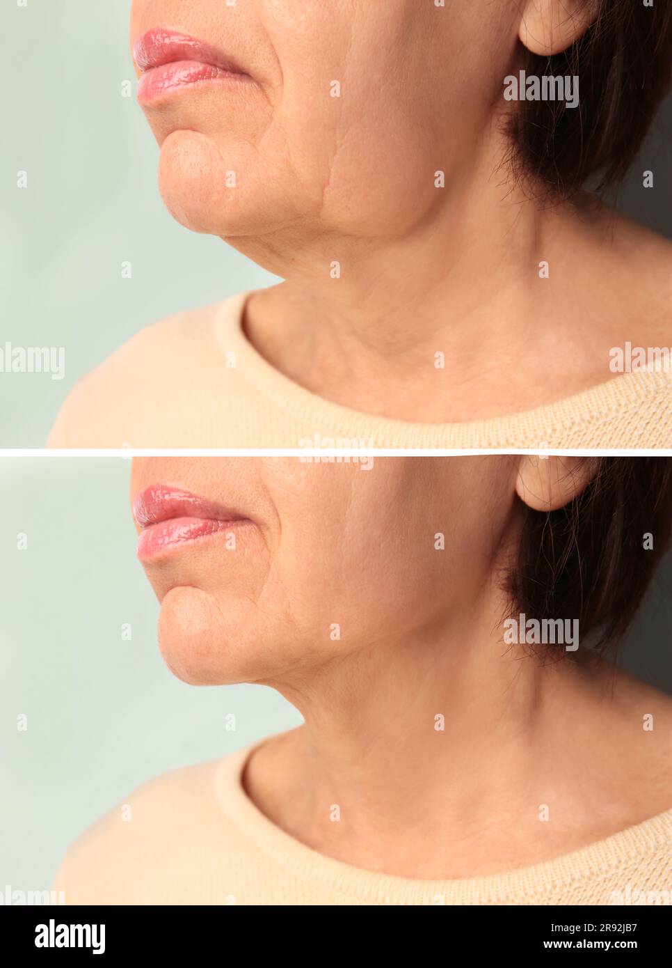 Double chin problem. Collage with photos of mature woman before and ...