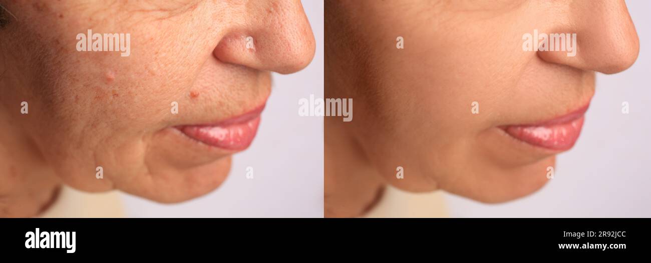 Woman before and after rejuvenating procedures. Collage with photos on ...