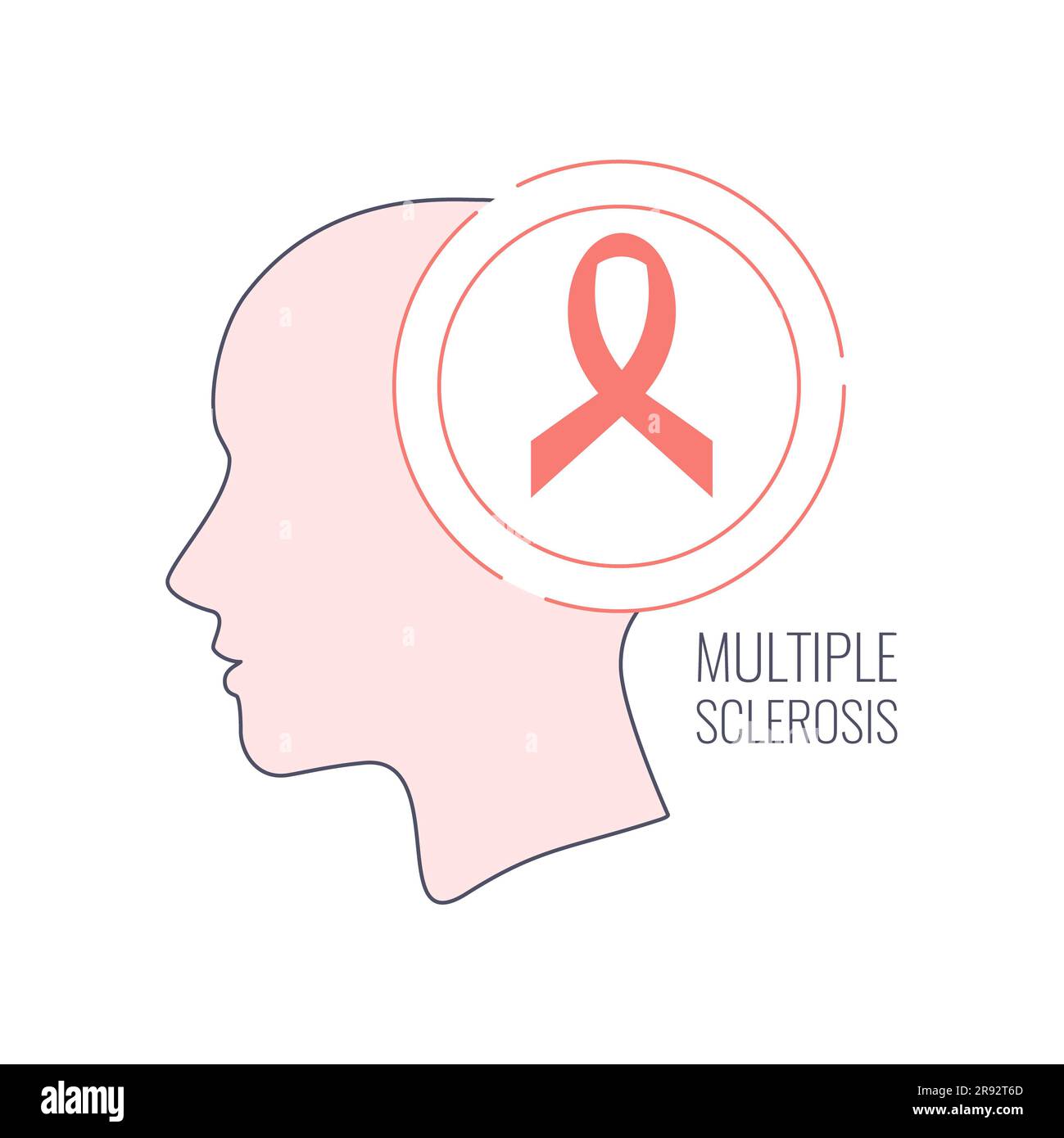 Multiple sclerosis, conceptual illustration Stock Photo - Alamy