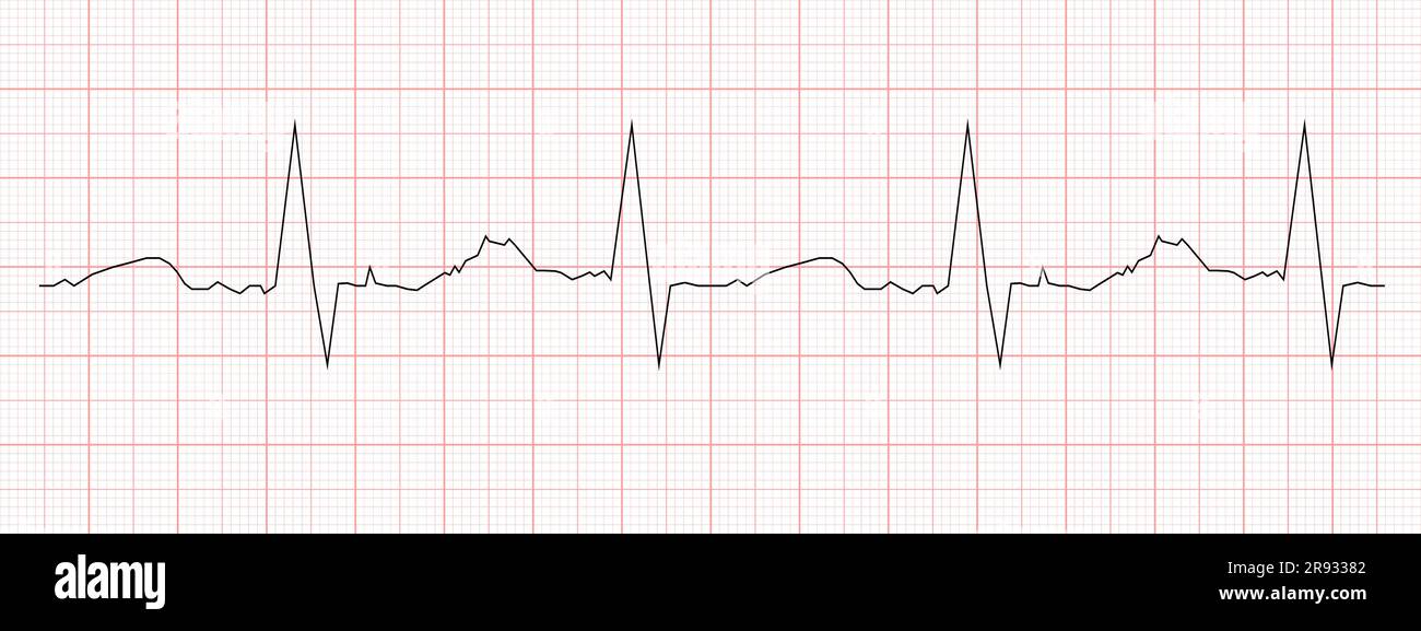 Black heart beat diagram printed on red graph paper. ECG chart. Cardiac ...