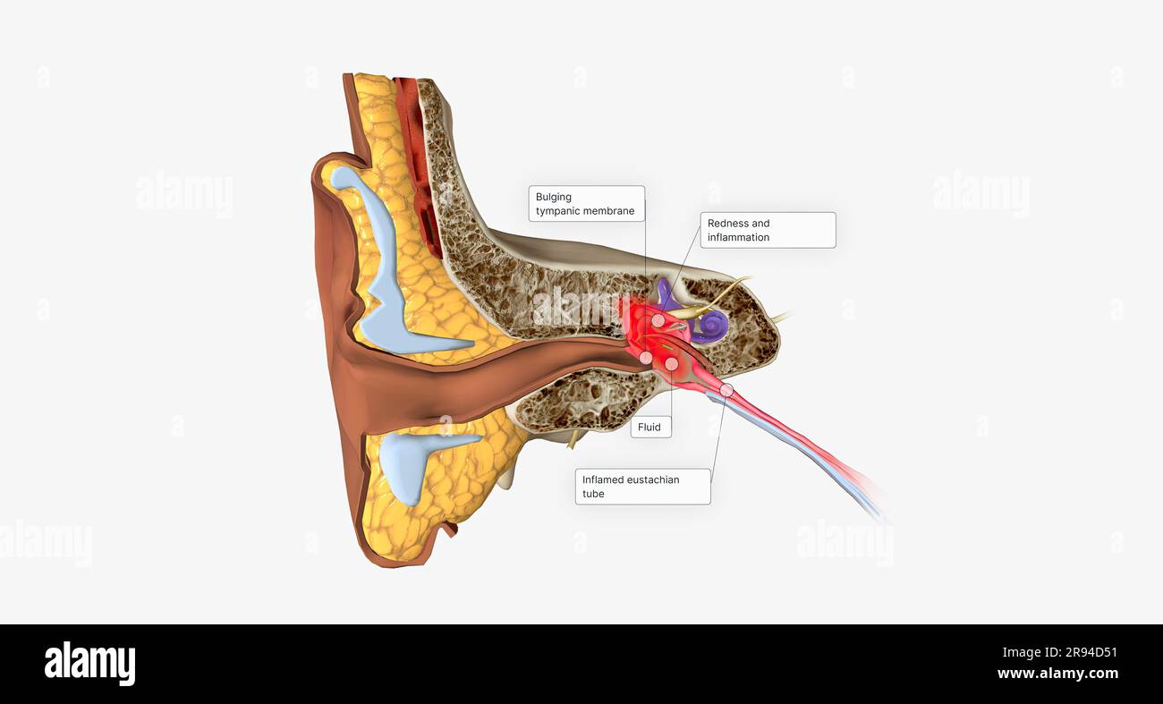 Acute otitis media is an infection and inflammation of the middle ear ...