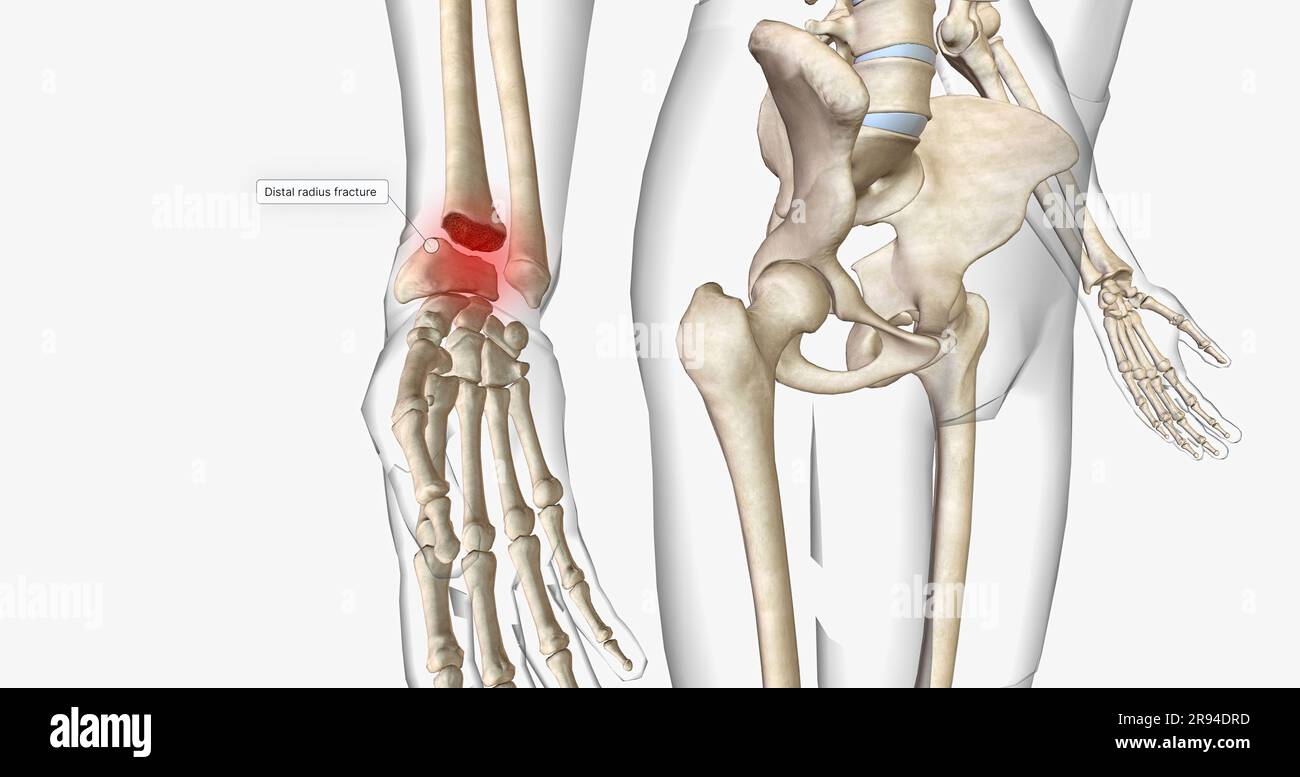 Broken upper arm bone Cut Out Stock Images & Pictures - Alamy