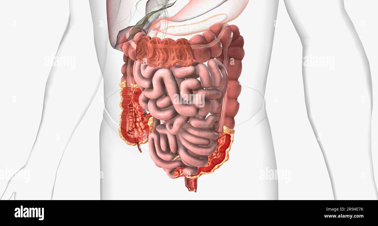 Crohn's disease rendering hi-res stock photography and images - Alamy