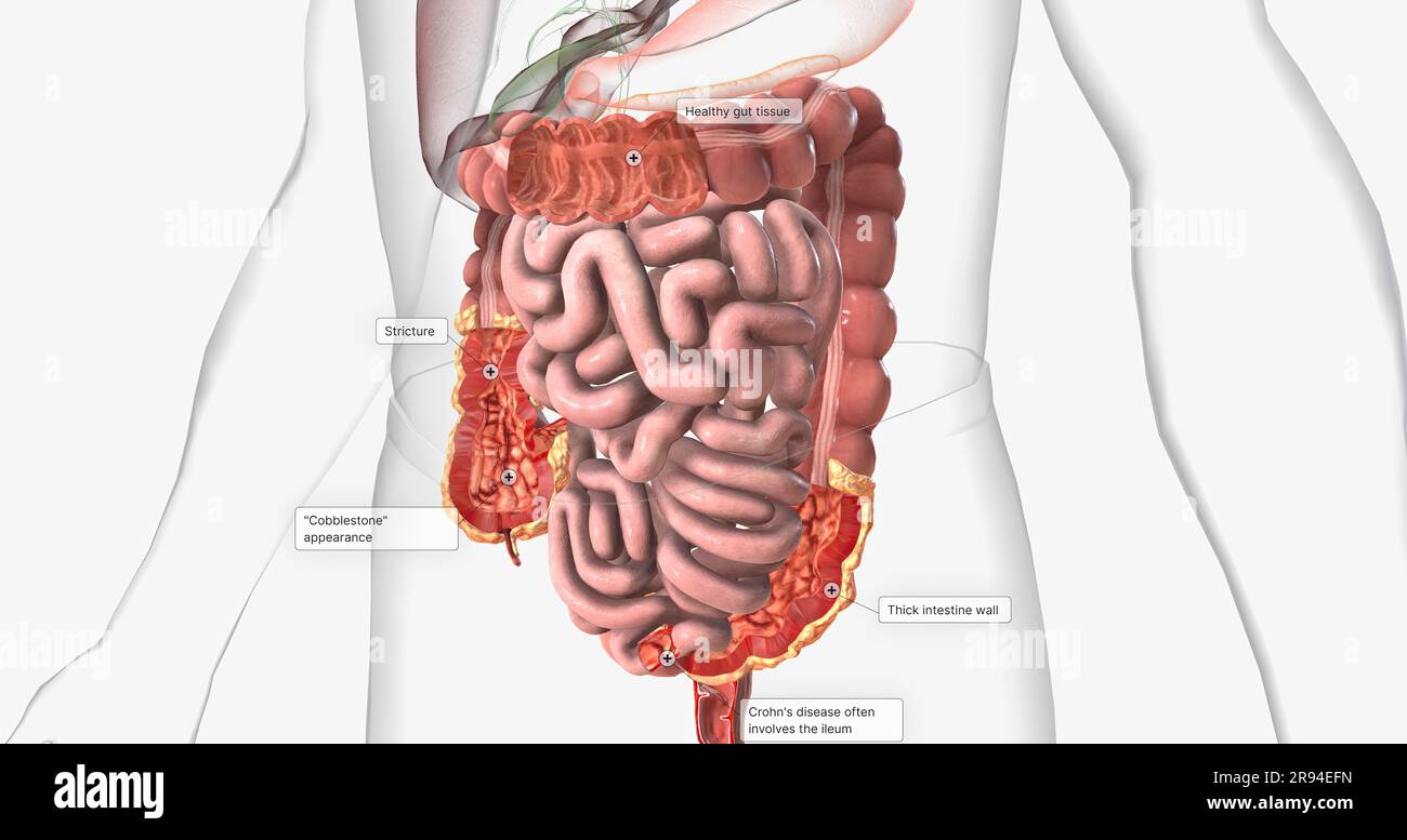 Crohn's disease rendering hi-res stock photography and images - Alamy