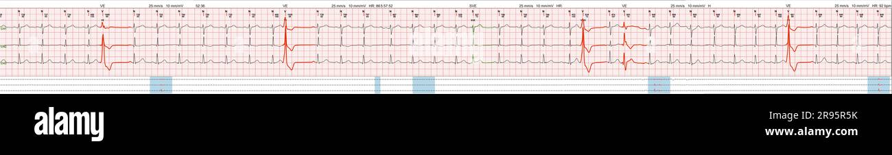Electrocardiography ECG test patient with charts scientific cardiograms ...