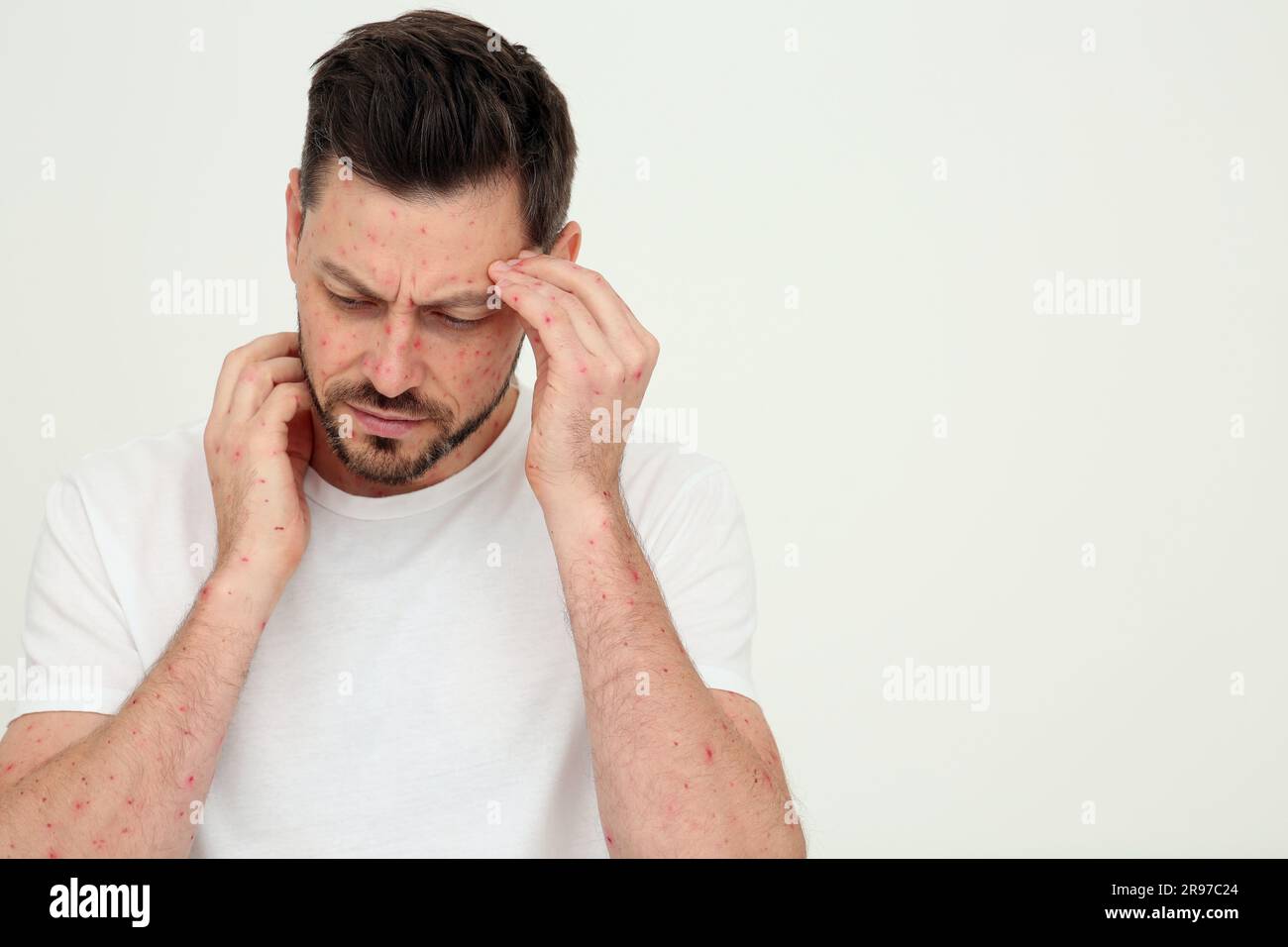 Man with rash from pox virus infection hi-res stock photography and ...