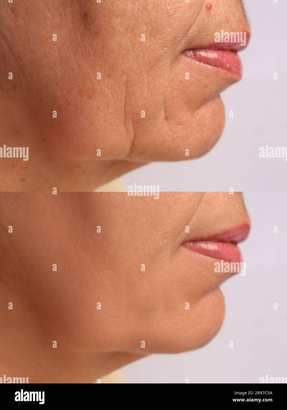 Woman before and after rejuvenating procedures. Collage with photos on ...