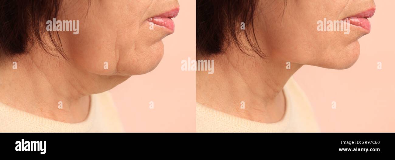 Double chin problem. Collage with photos of mature woman before and ...