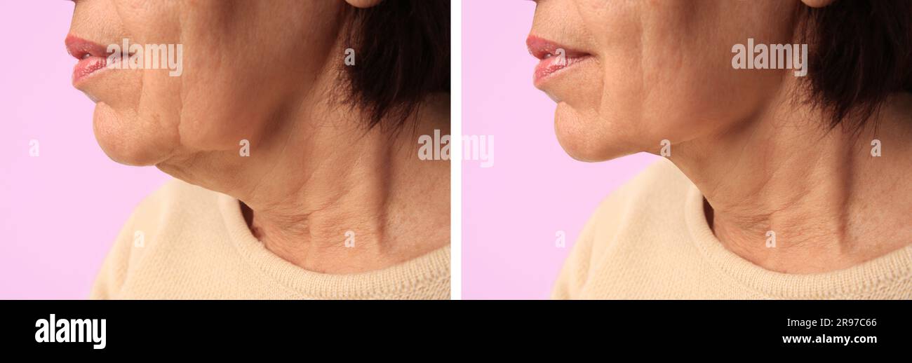 Double chin problem. Collage with photos of mature woman before and ...