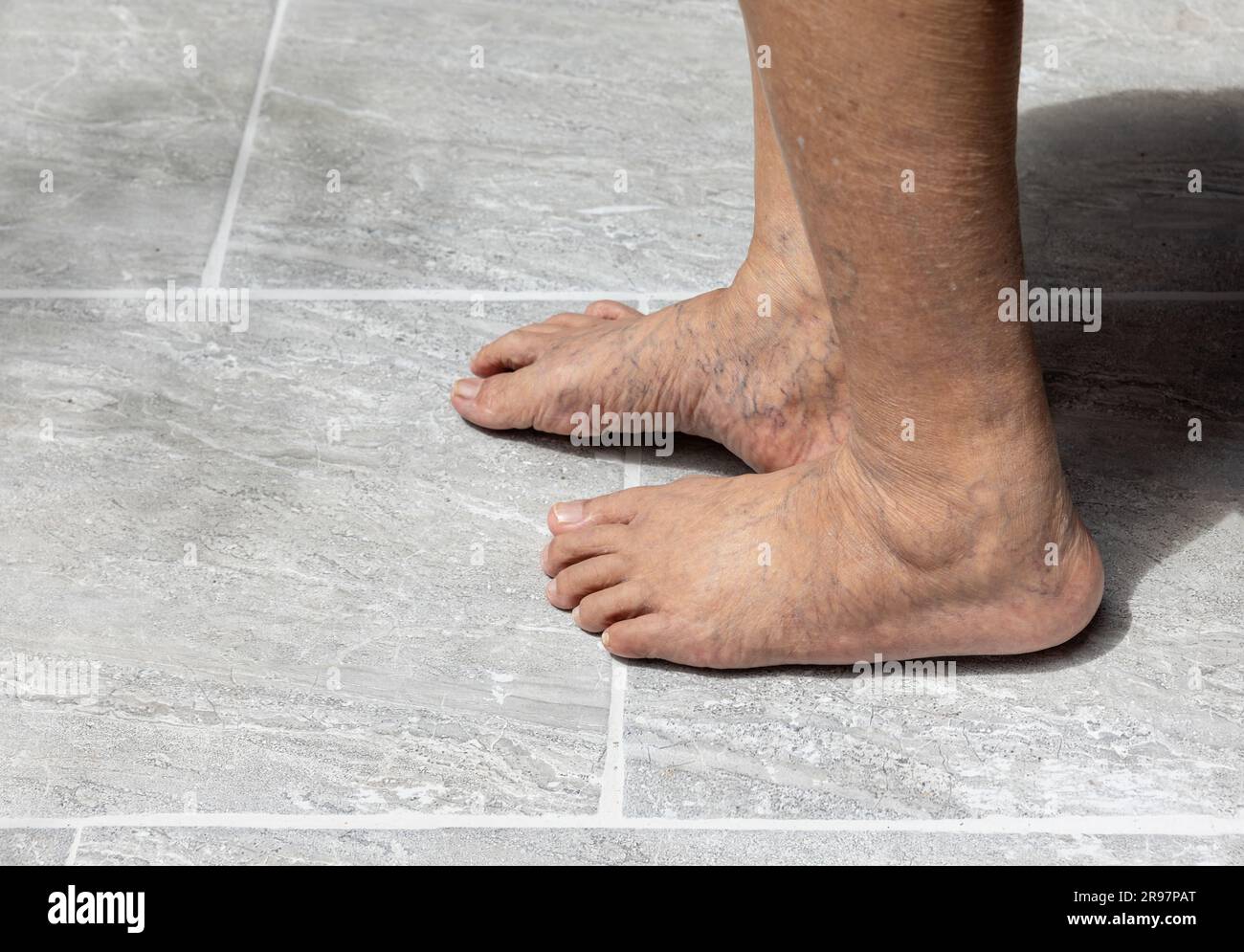 Elderly woman feet have varicose veins Stock Photo - Alamy