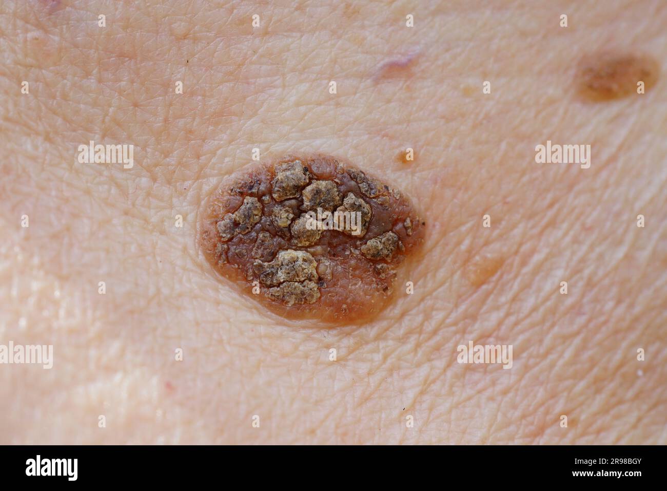 Mole examination hi-res stock photography and images - Alamy