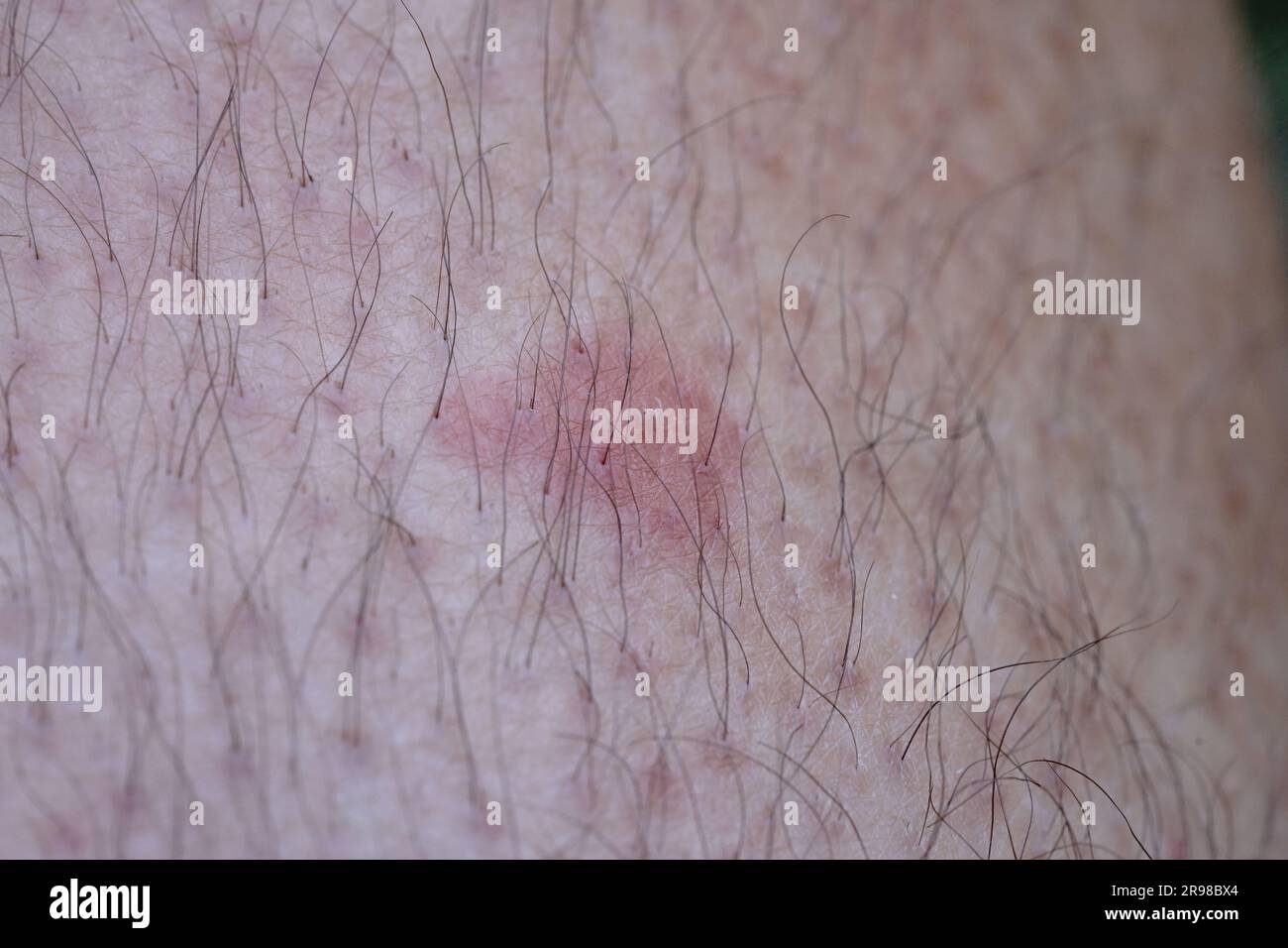 Insect bite marks hi-res stock photography and images - Alamy