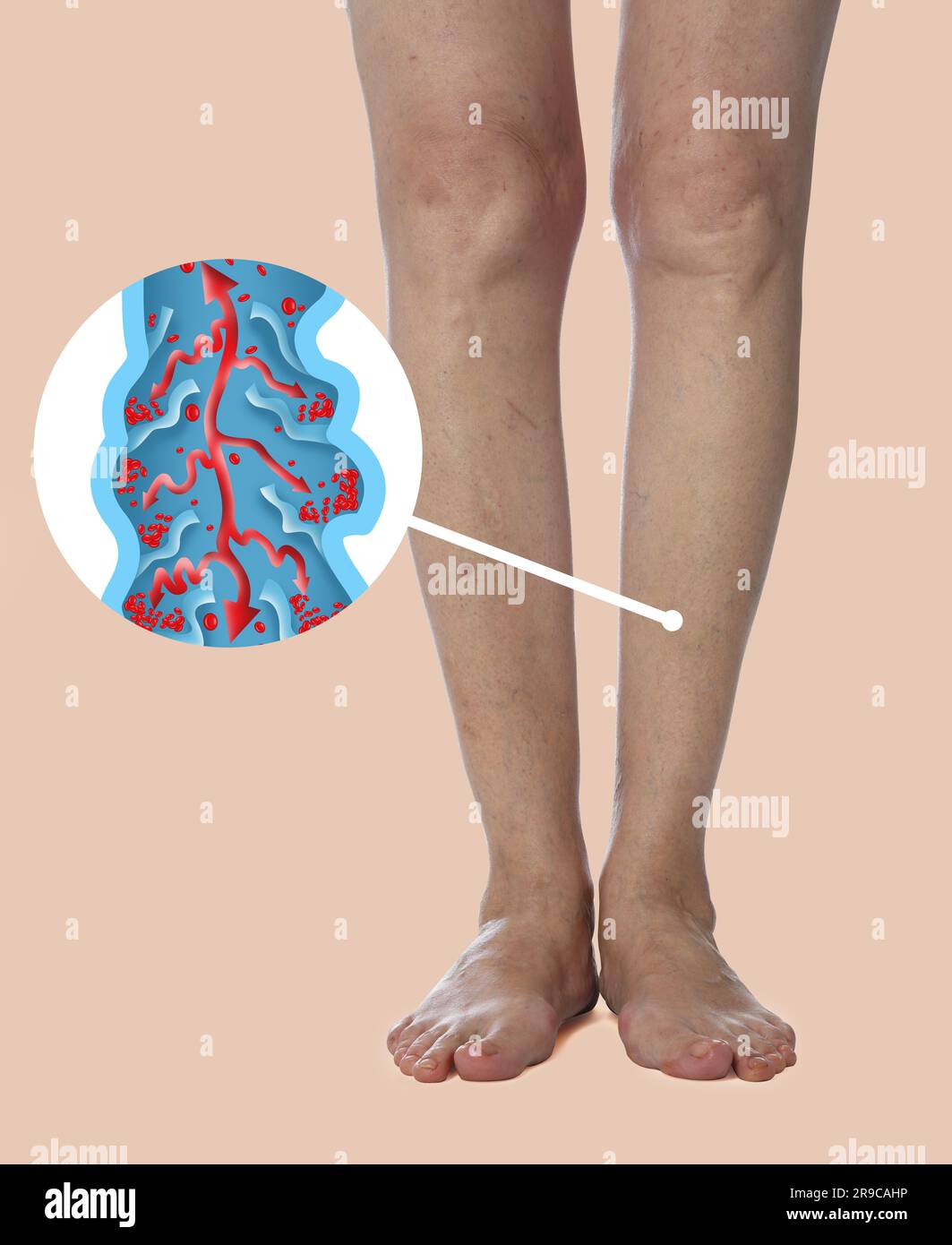 Closeup view of woman with varicose veins on beige background ...
