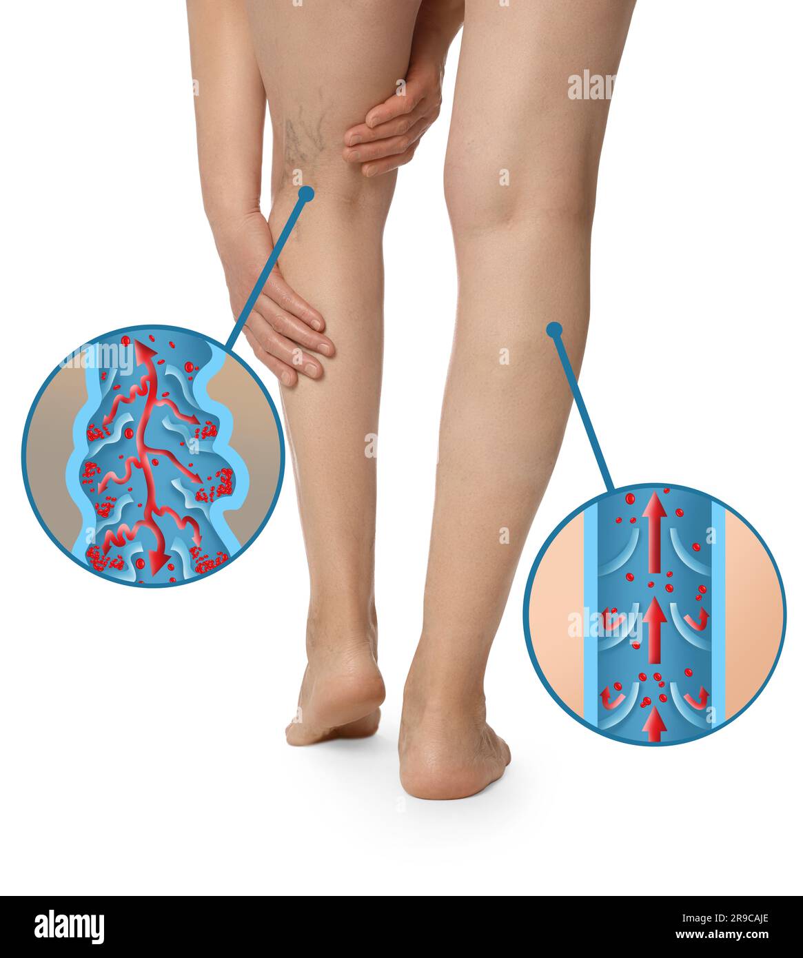 Closeup view of woman with varicose veins on white background ...