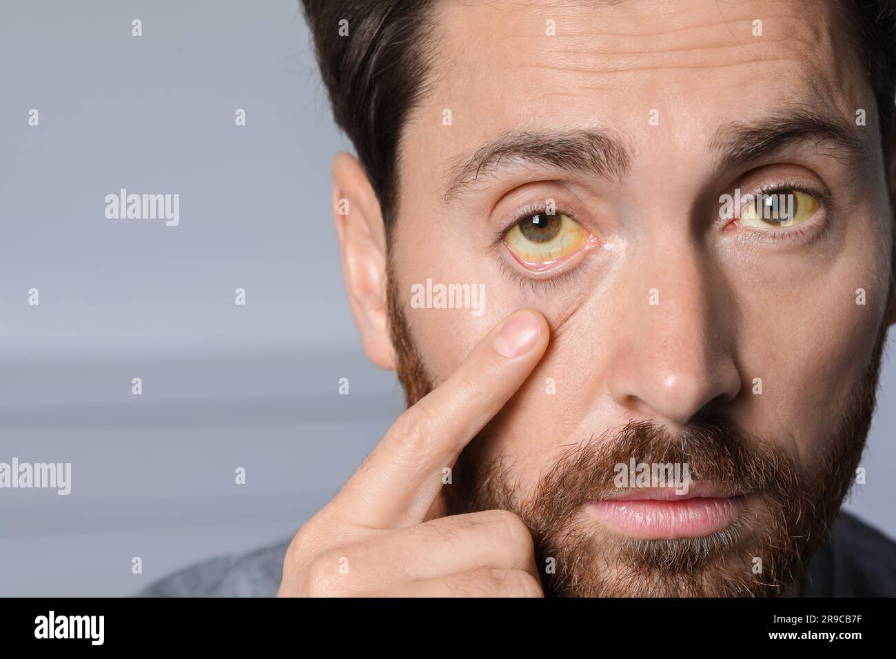 Man with yellow eyes on blurred background, closeup. Symptom of ...