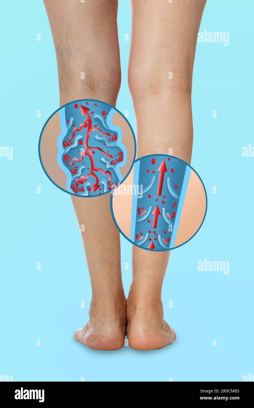 Closeup view of woman with varicose veins on light blue background ...