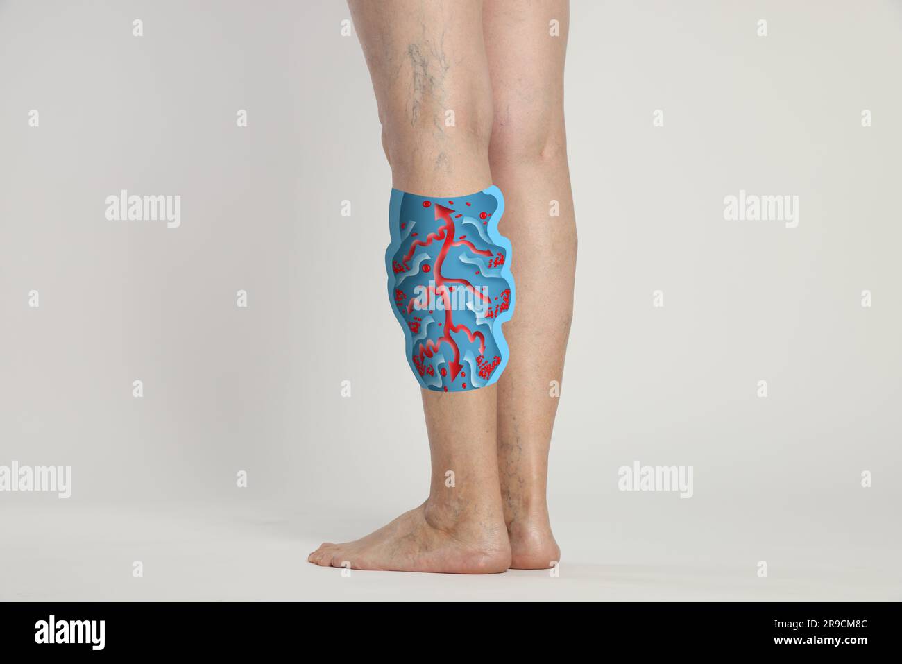 Closeup view of woman with varicose veins on white background ...