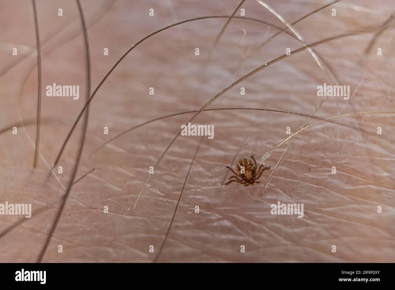 A close-up of a small tick attached to a person's skin Stock Photo - Alamy