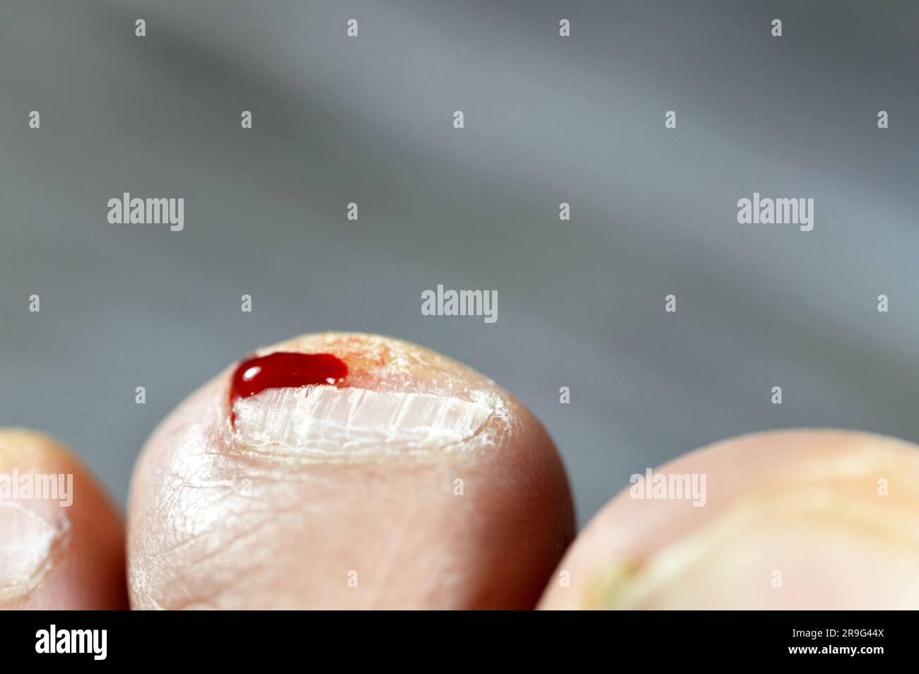 Bleeding on the tip of the second toe of the left foot, insult of the ...