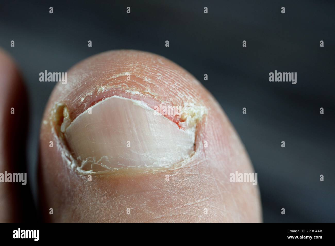 Ingrown toenail of the big toe of the foot is a common condition in ...