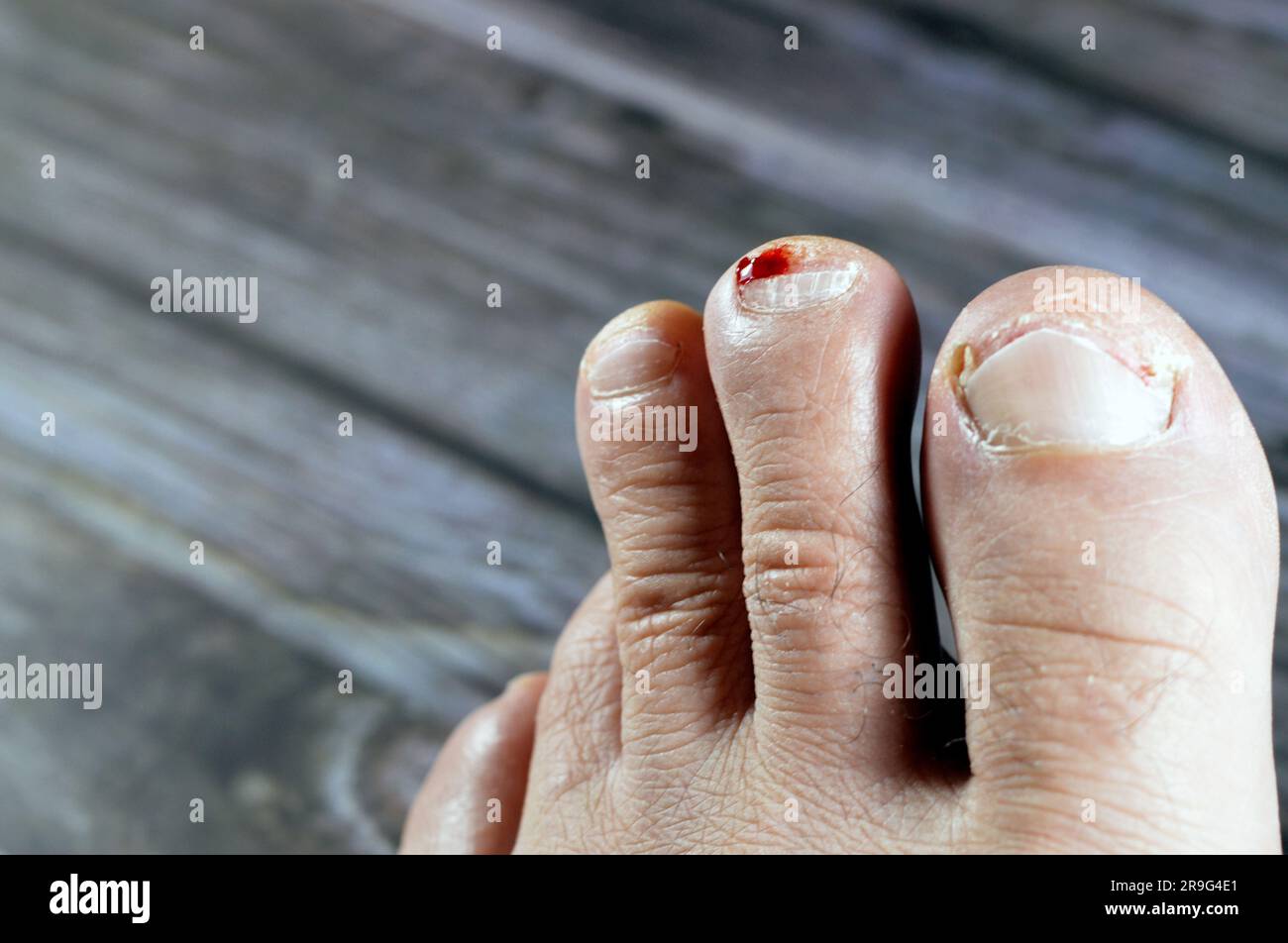 Bleeding on the tip of the second toe of the left foot, insult of the ...