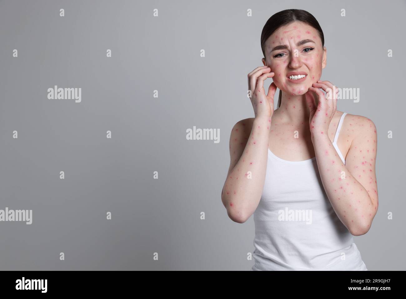 Woman with rash suffering from monkeypox virus on light grey background ...