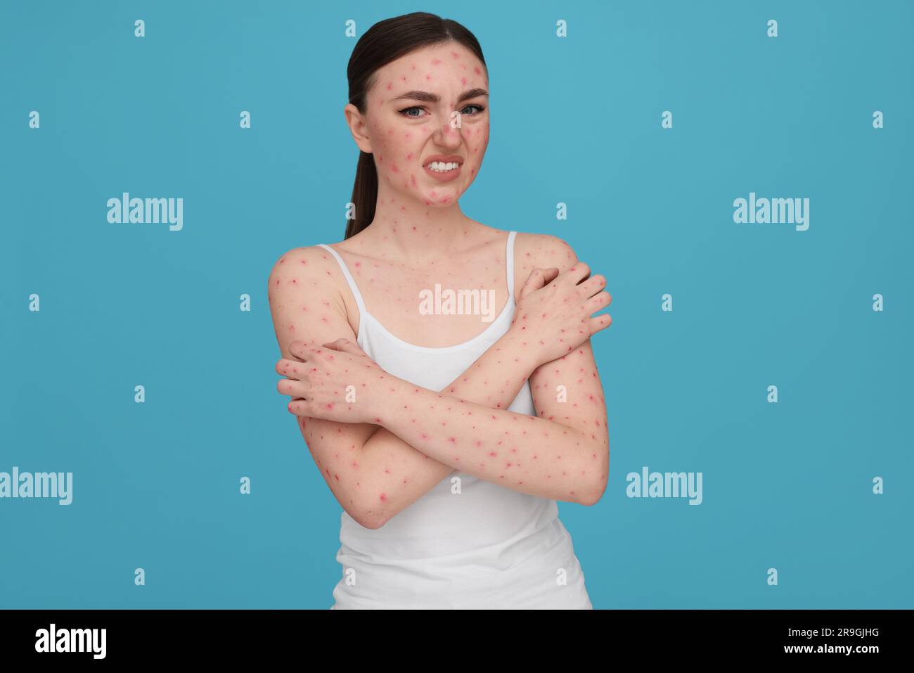 Woman with rash suffering from monkeypox virus on light blue background ...