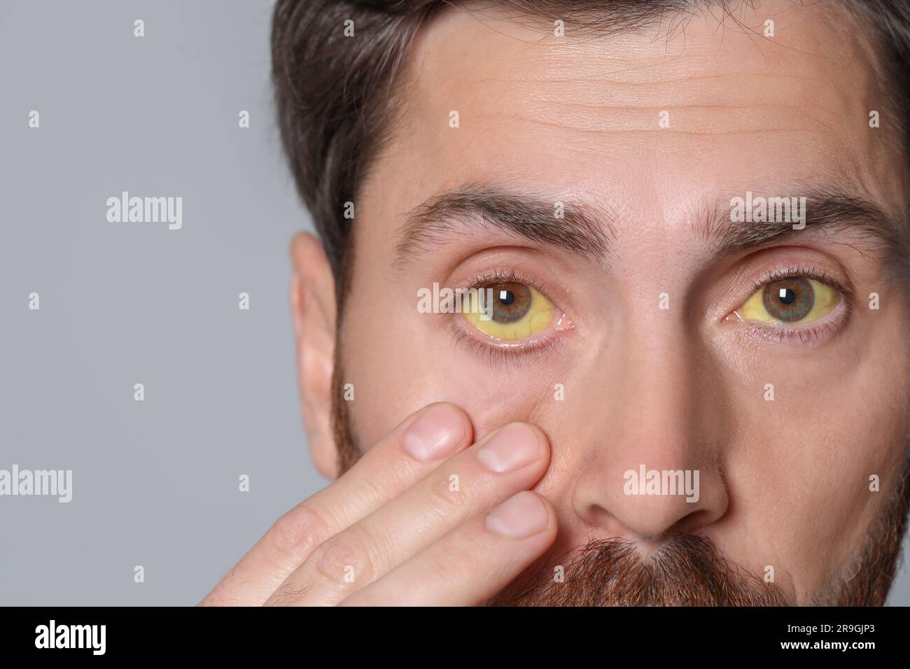 Man with yellow eyes on grey background, closeup. Symptom of hepatitis ...