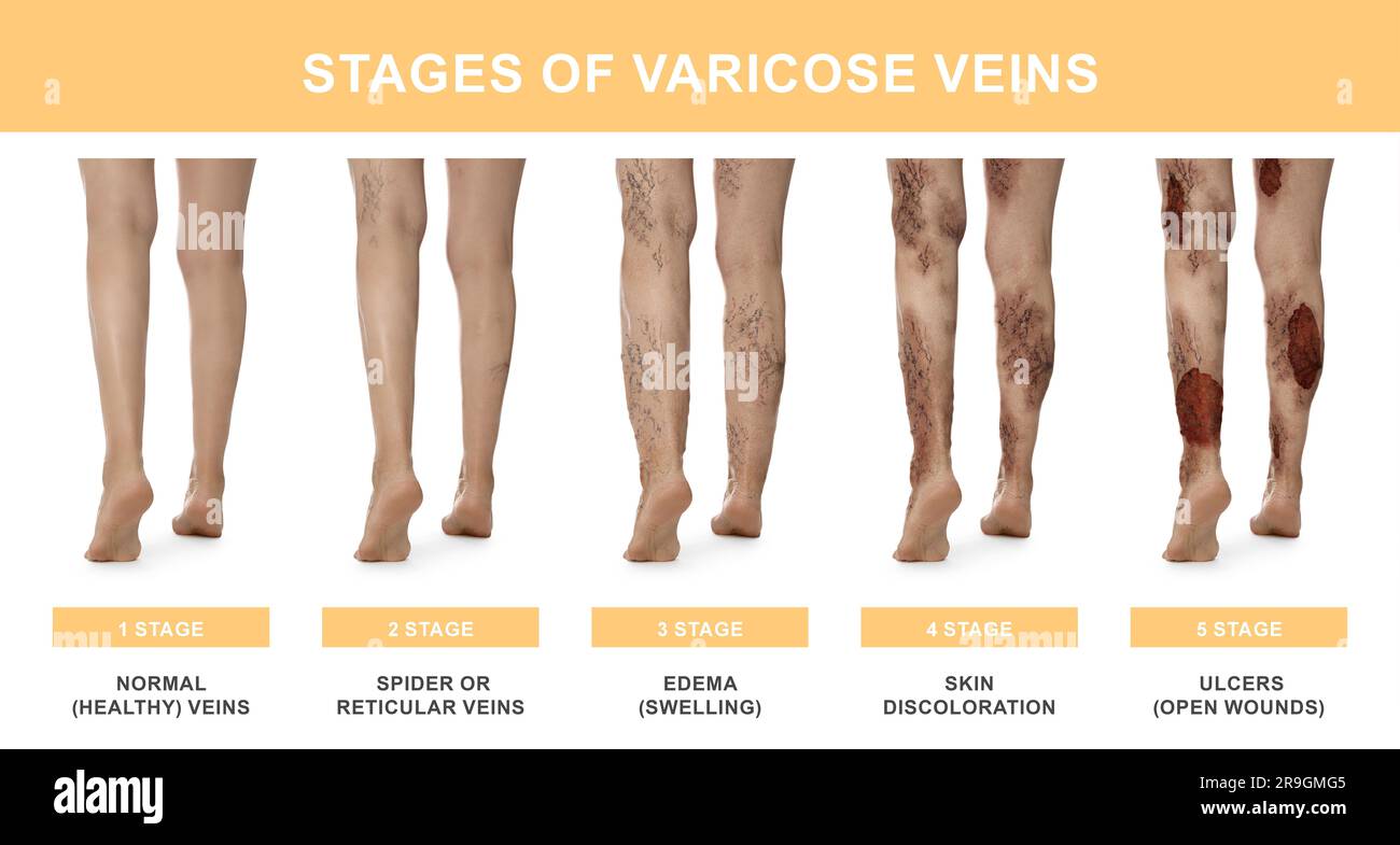 Stages of varicose veins. Collage with photos of woman showing changes ... Stages of varicose veins. Collage with photos of woman showing changes ...