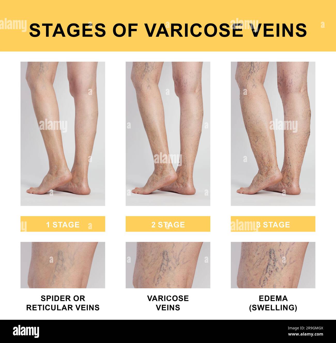 Stages of varicose veins. Photos of woman and zoomed skin area, closeup ...