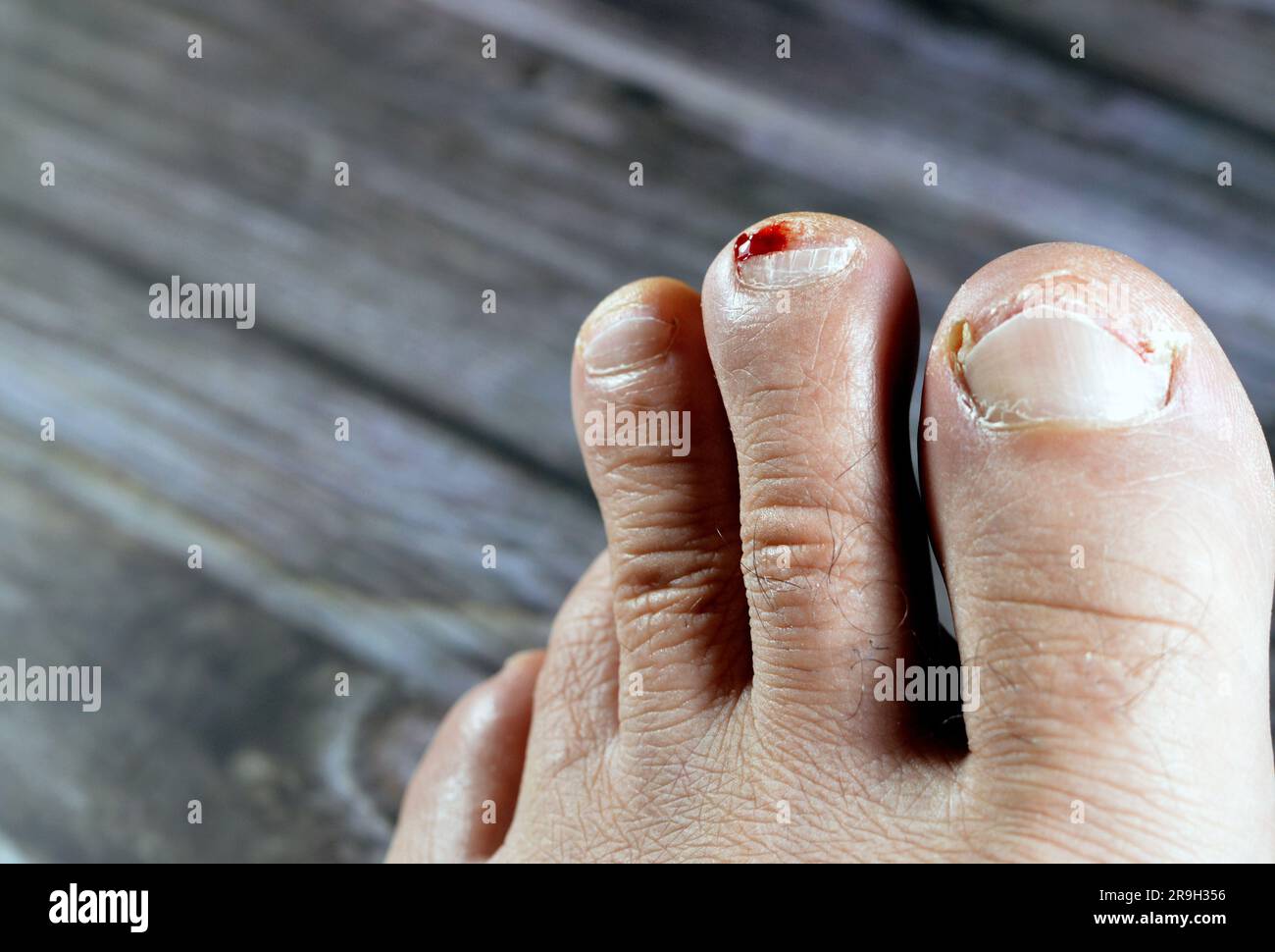 Bleeding on the tip of the second toe of the left foot, insult of the ...