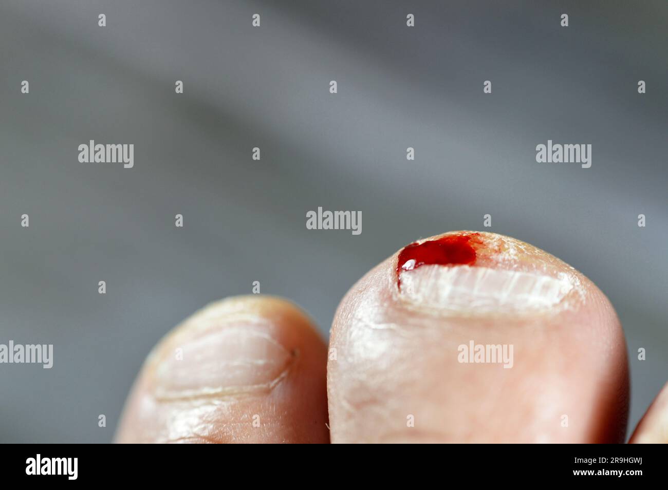 Bleeding on the tip of the second toe of the left foot, insult of the ...