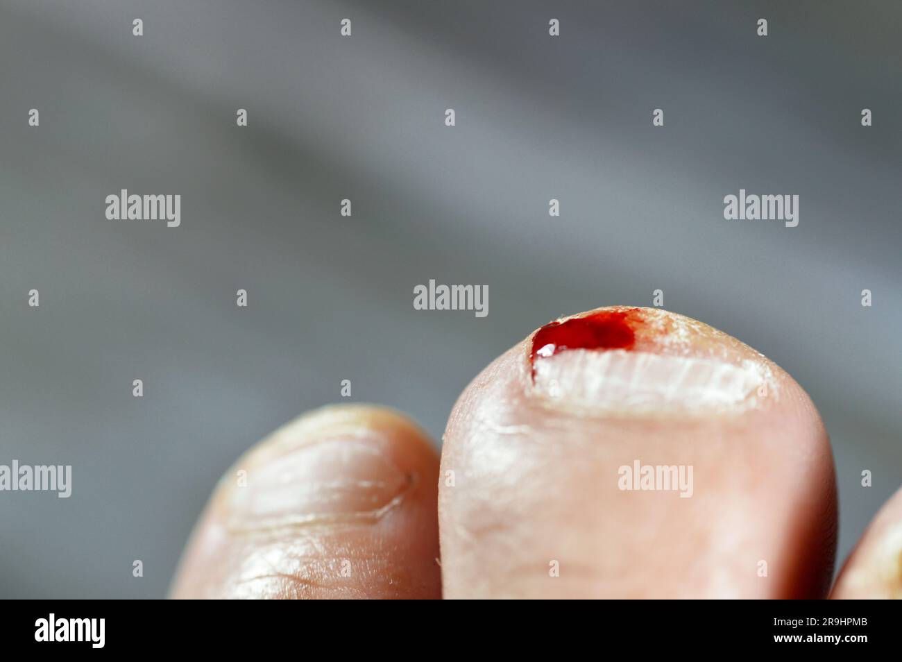 Bleeding on the tip of the second toe of the left foot, insult of the ...