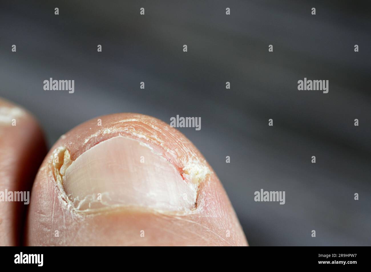 Ingrown toenail of the big toe of the foot is a common condition in ...