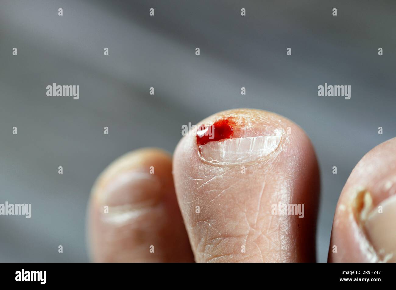 Bleeding on the tip of the second toe of the left foot, insult of the ...