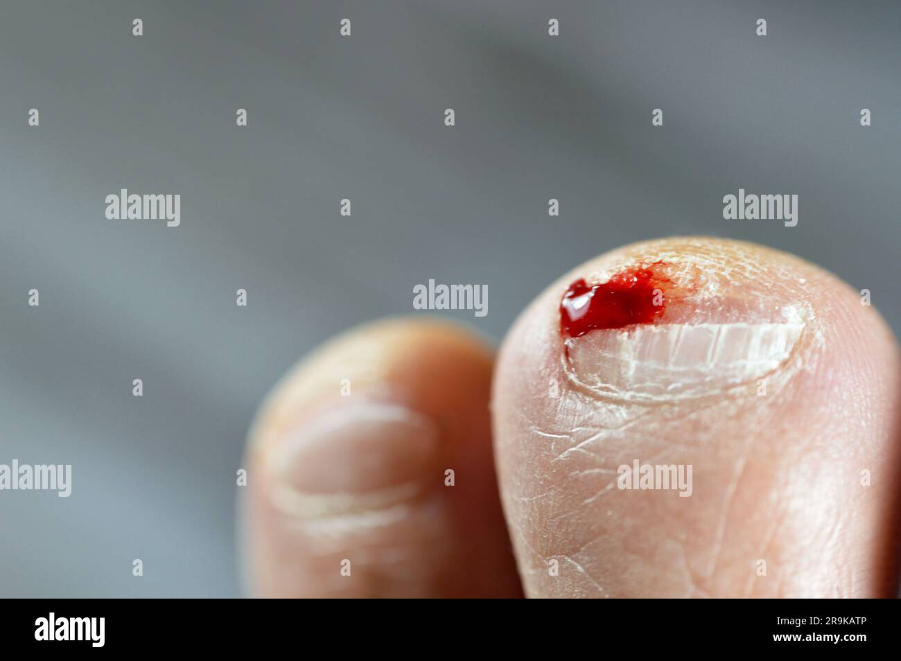 Bleeding on the tip of the second toe of the left foot, insult of the ...