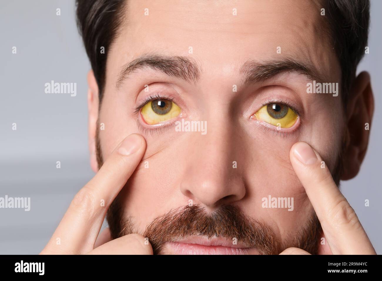 Man with yellow eyes on blurred background, closeup. Symptom of ...