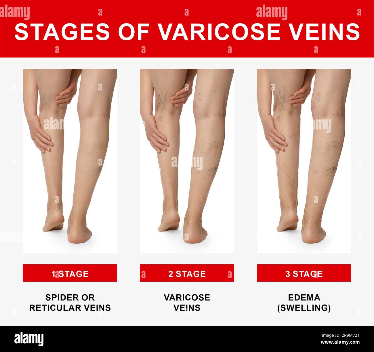 Stages of varicose veins. Collage with photos of woman showing changes ...