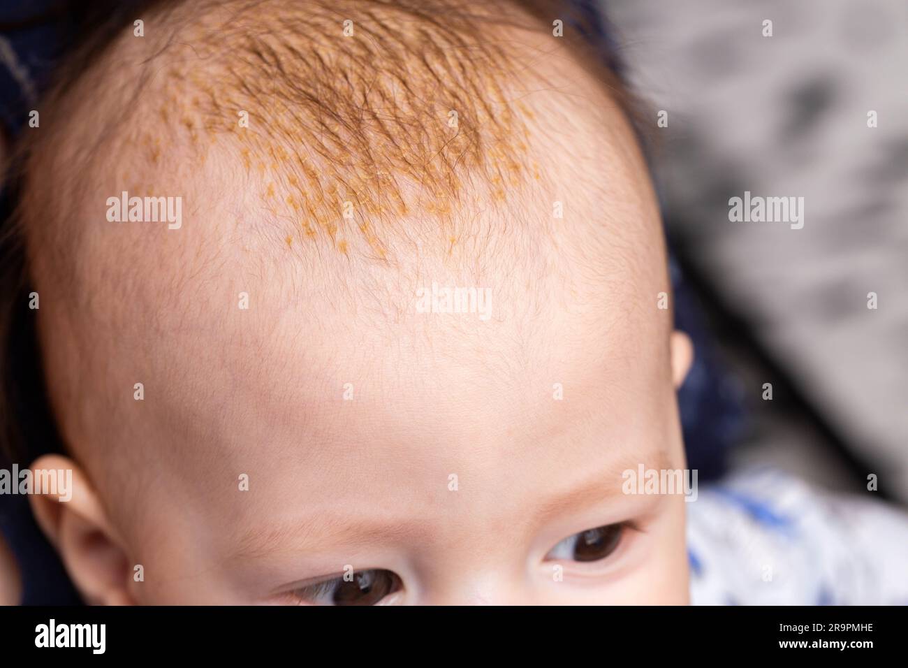 Milk crusts on the head of a newborn child, gneiss. The formation of ...