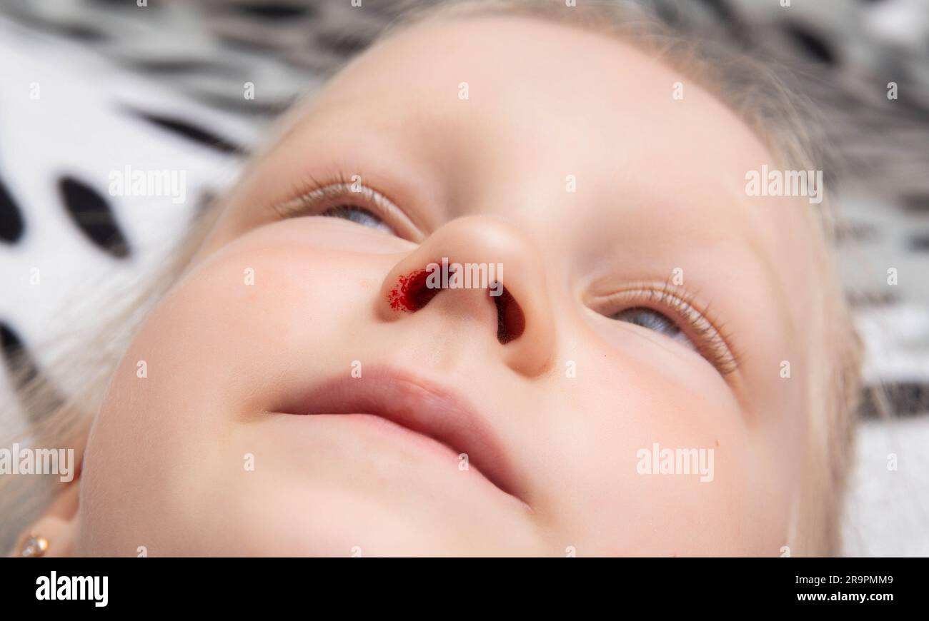 The face of a little caucasian girl with a nosebleed. Nosebleeds in ...