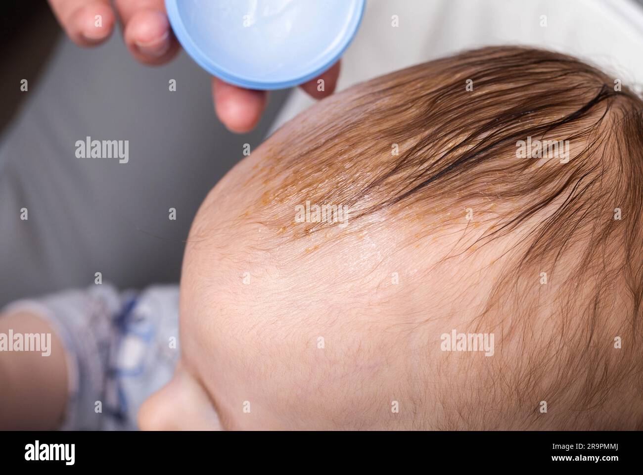 Applying a special cream and oil to the child's scalp to remove gneiss ...