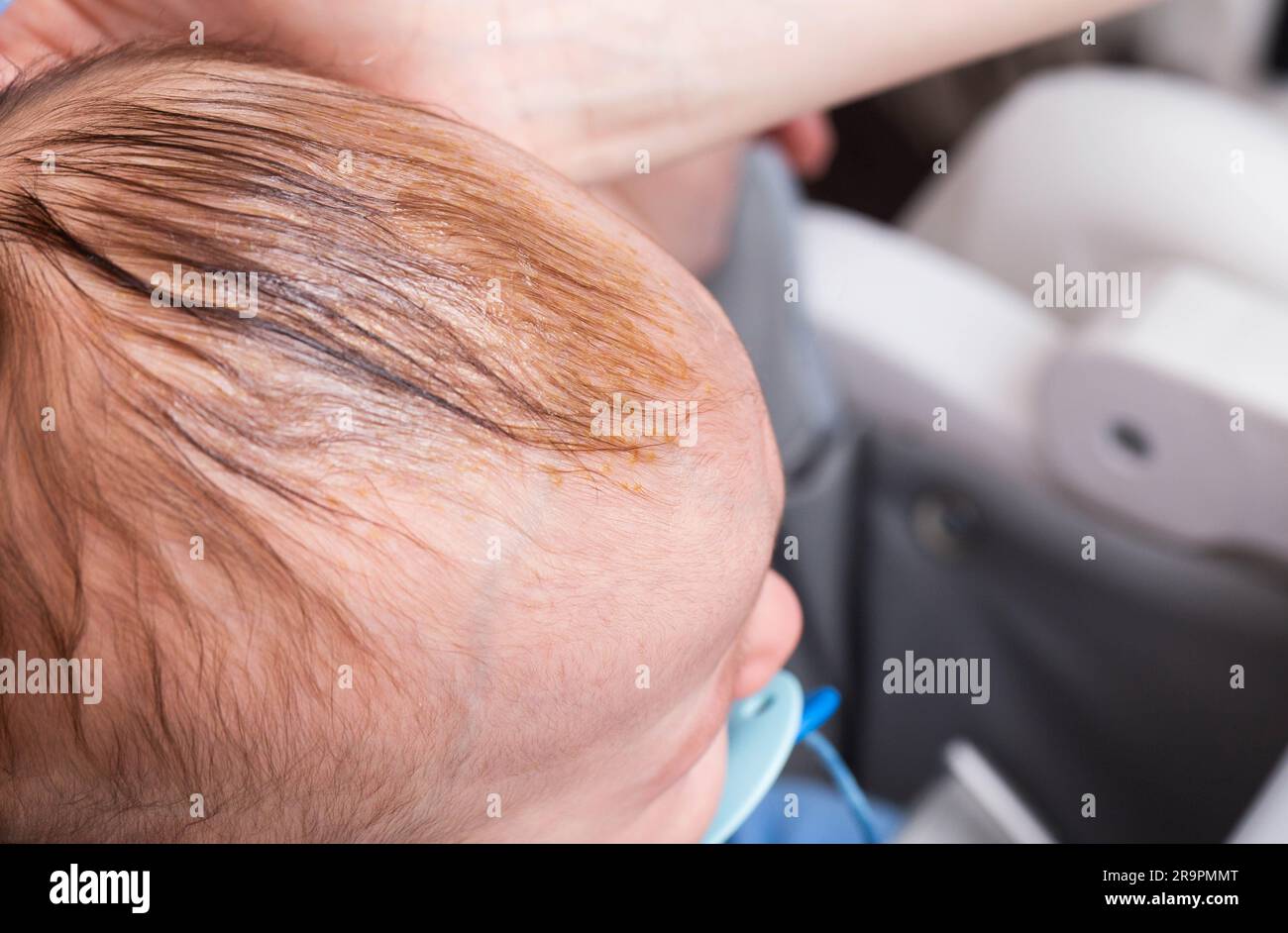Smearing a seborrheic crust with baby oil on a child's head. Combing ...