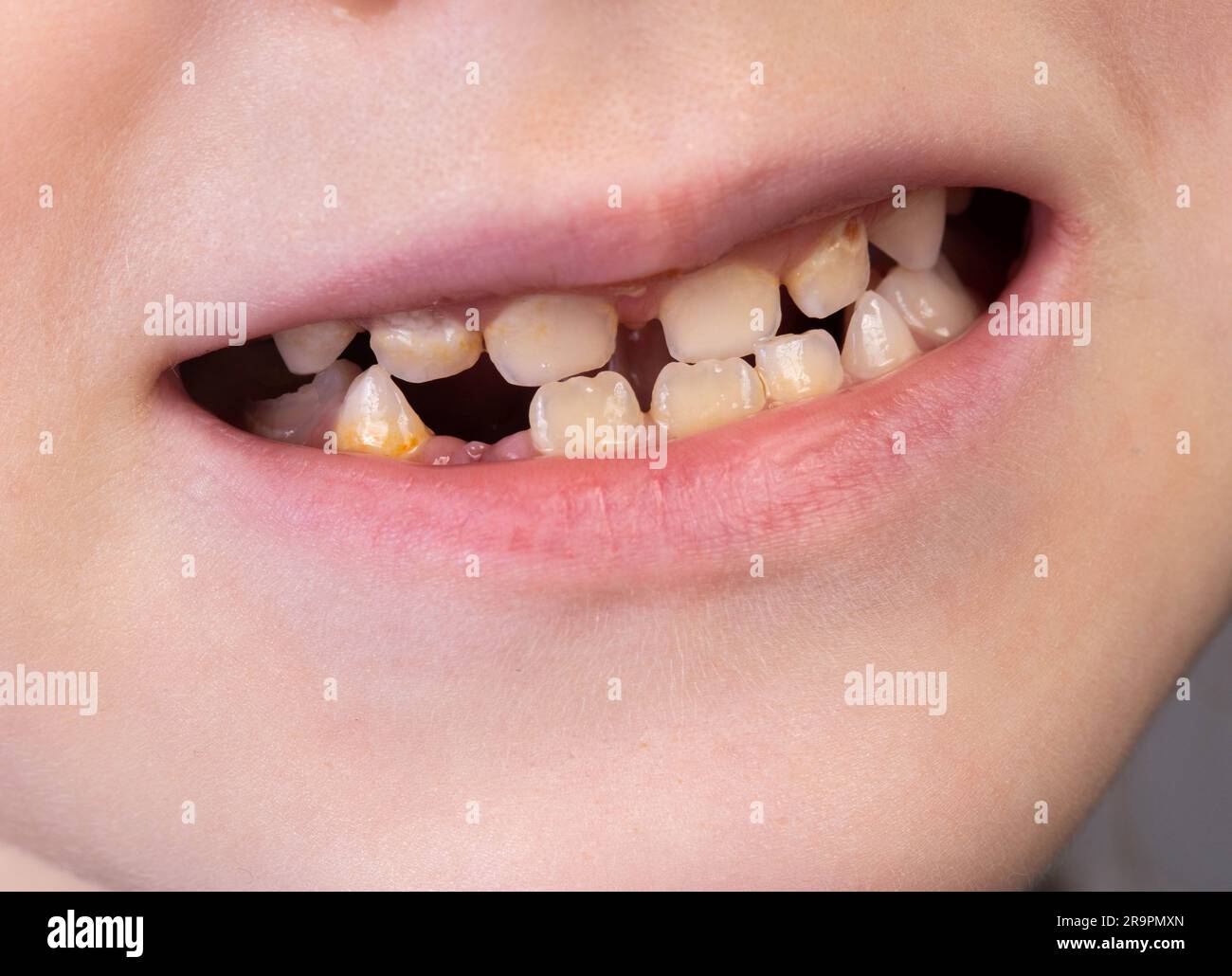 Mouth and smile of a child without one tooth. Loss of milk teeth in ...